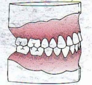 Angle classification of malocclusion - Dental Dictionary