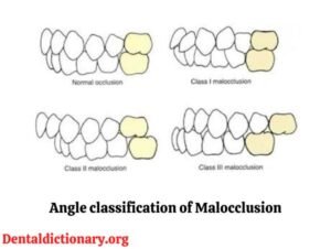 Angle classification of malocclusion - Dental Dictionary