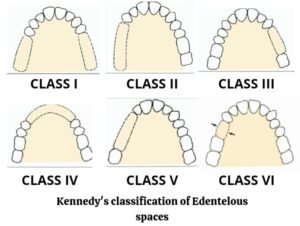 Kennedy's classification of Edentulous arch & Applegates rules