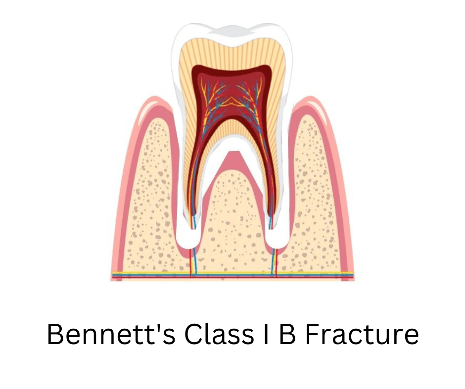 Bennett's Classification of Tooth Fracture - Dental Dictionary