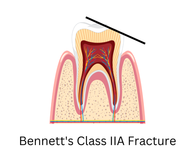 Bennett's Classification of Tooth Fracture - Dental Dictionary