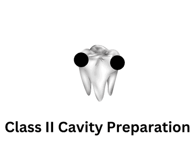Cavity Preparation Classification by GV Black - Dental Dictionary