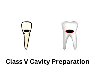 Cavity Preparation Classification by GV Black - Dental Dictionary