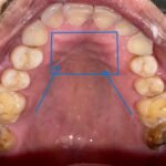 Palatal Rugae - Dental Dictionary